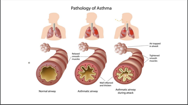 Pediatric Asthma Care in Acton